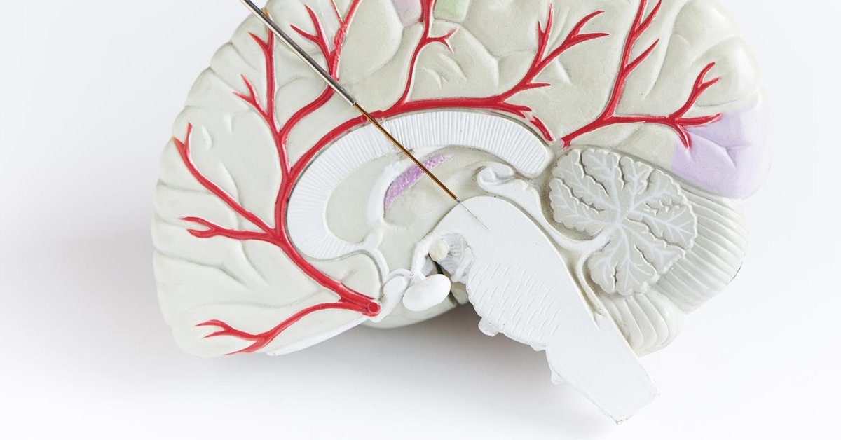 Optimization of deep brain stimulation for depression | Amsterdam UMC