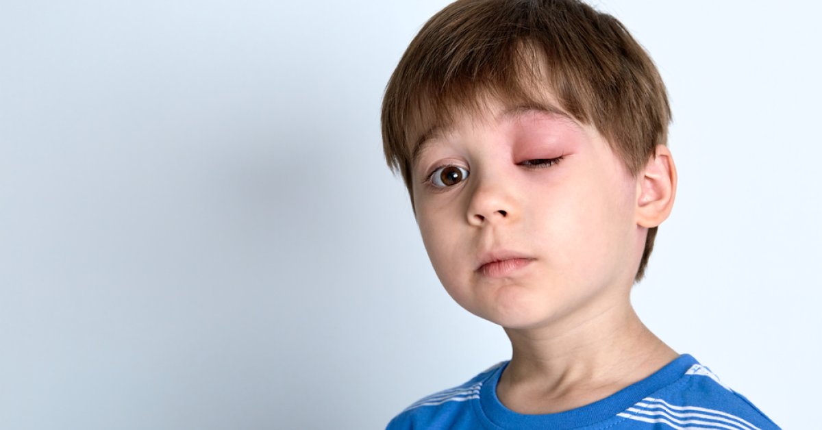 Nieuw medicijn werkt goed tegen zeldzame zwellingsziekte | Amsterdam UMC